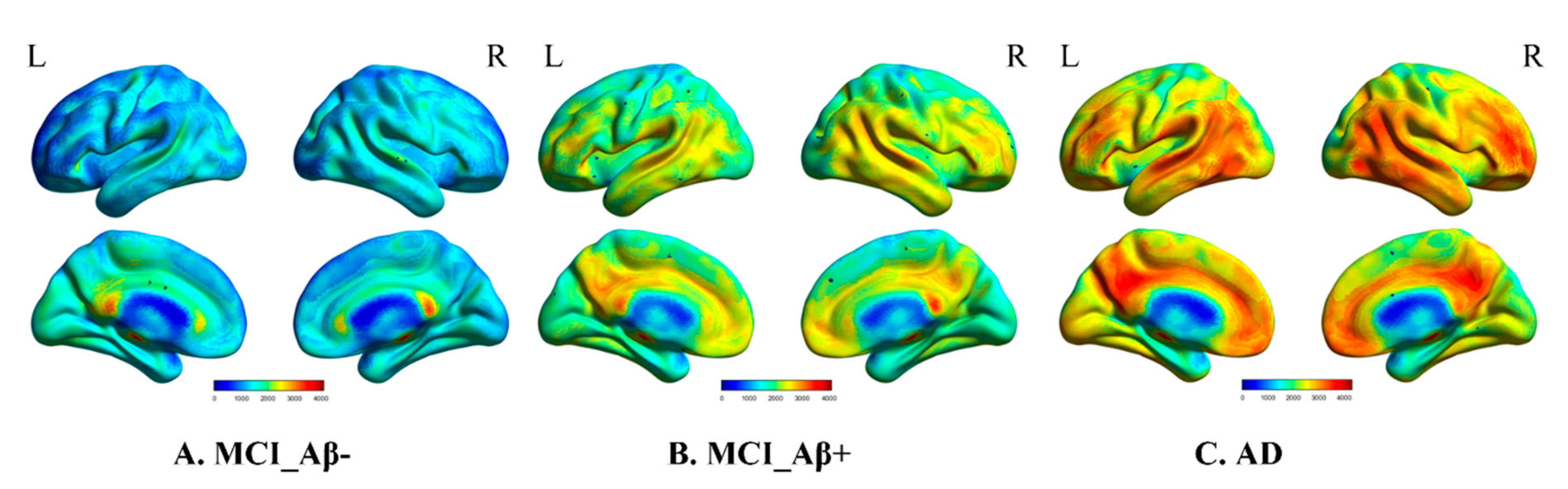 Relationship between Amyloid-β Deposition and the Coupling between ...