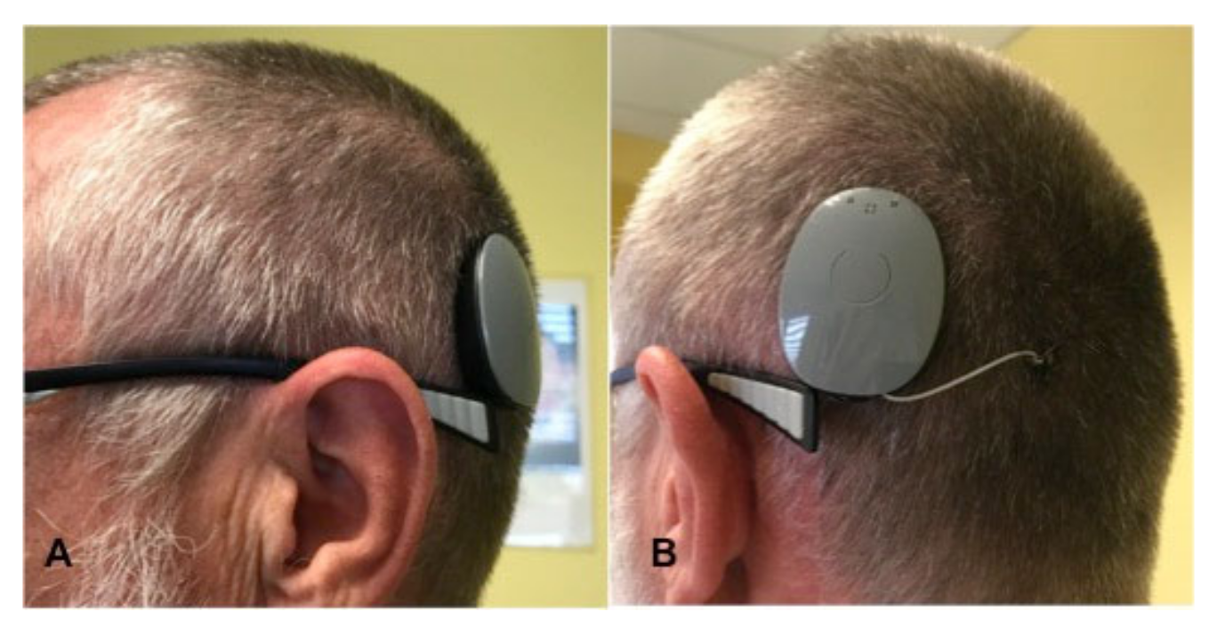 Hearing Rehabilitation with Cochlear Implants after CyberKnife ...