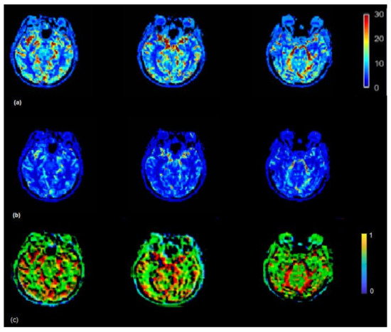 Optimal Scaling Approaches for Perfusion MRI with Distorted Arterial Input Function (AIF) in ...