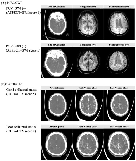 Clinical Implications of Prominent Cortical Vessels on Susceptibility ...