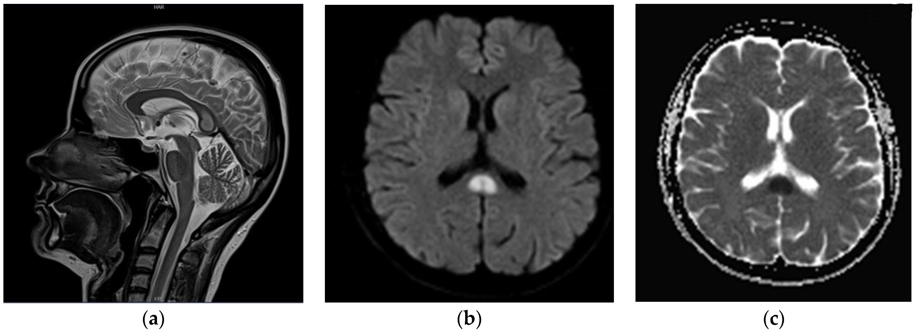 An Equivocal SCC Lesion—Antiepileptic-Induced CLOCC