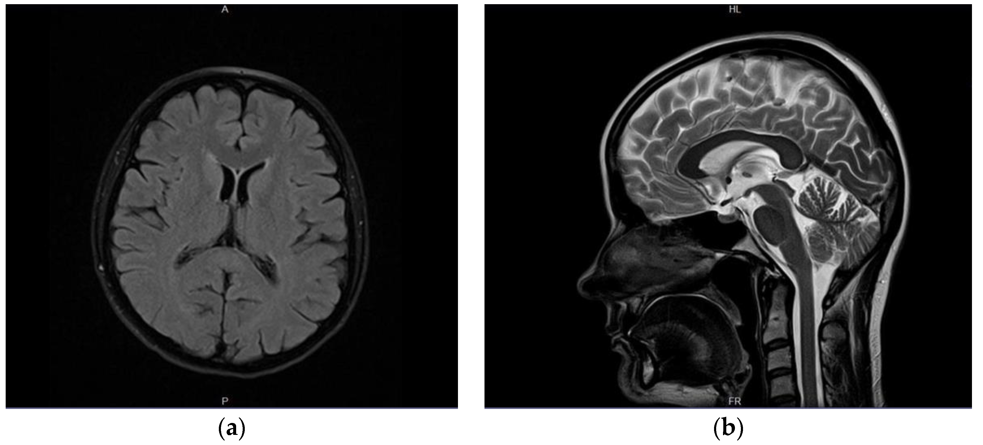 An Equivocal SCC Lesion—Antiepileptic-Induced CLOCC