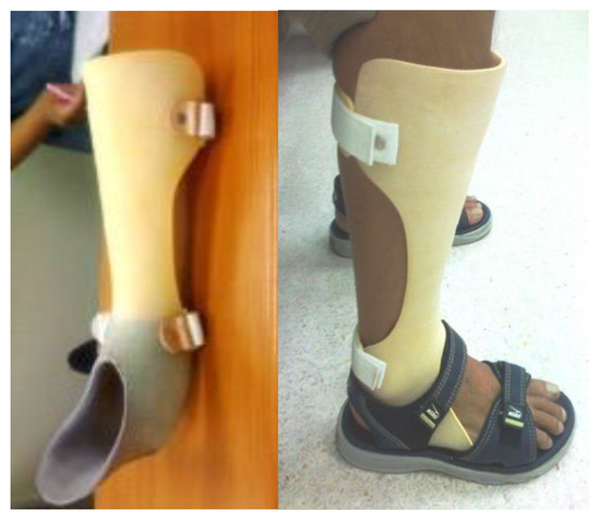 Anterior or Posterior Ankle Foot Orthoses for Ankle Spasticity: Which ...