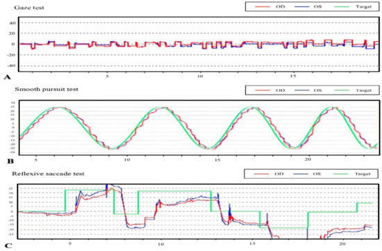 Eye Movement Abnormalities in Amyotrophic Lateral Sclerosis