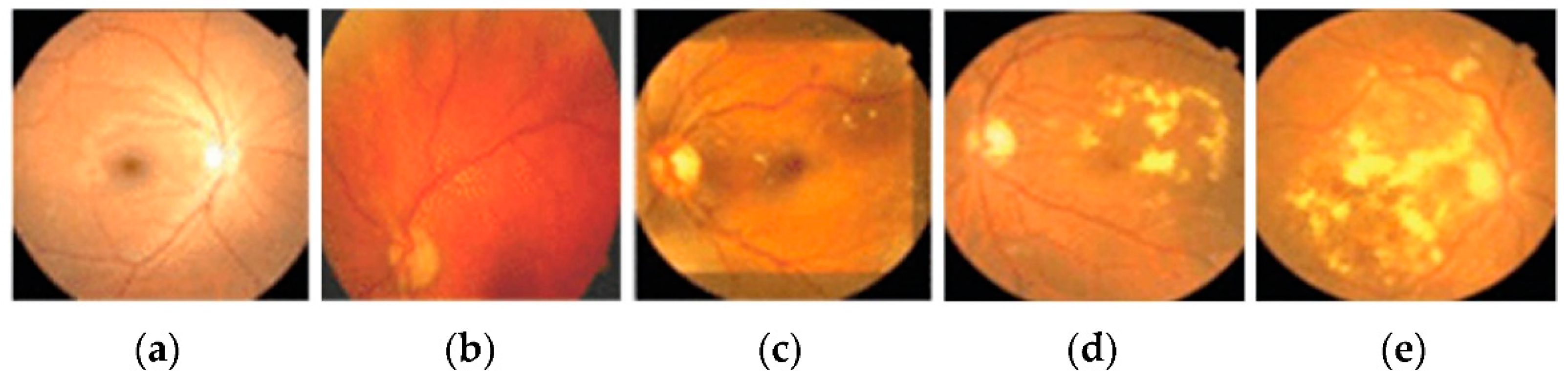 Transfer Learning-Based Model for Diabetic Retinopathy Diagnosis Using ...