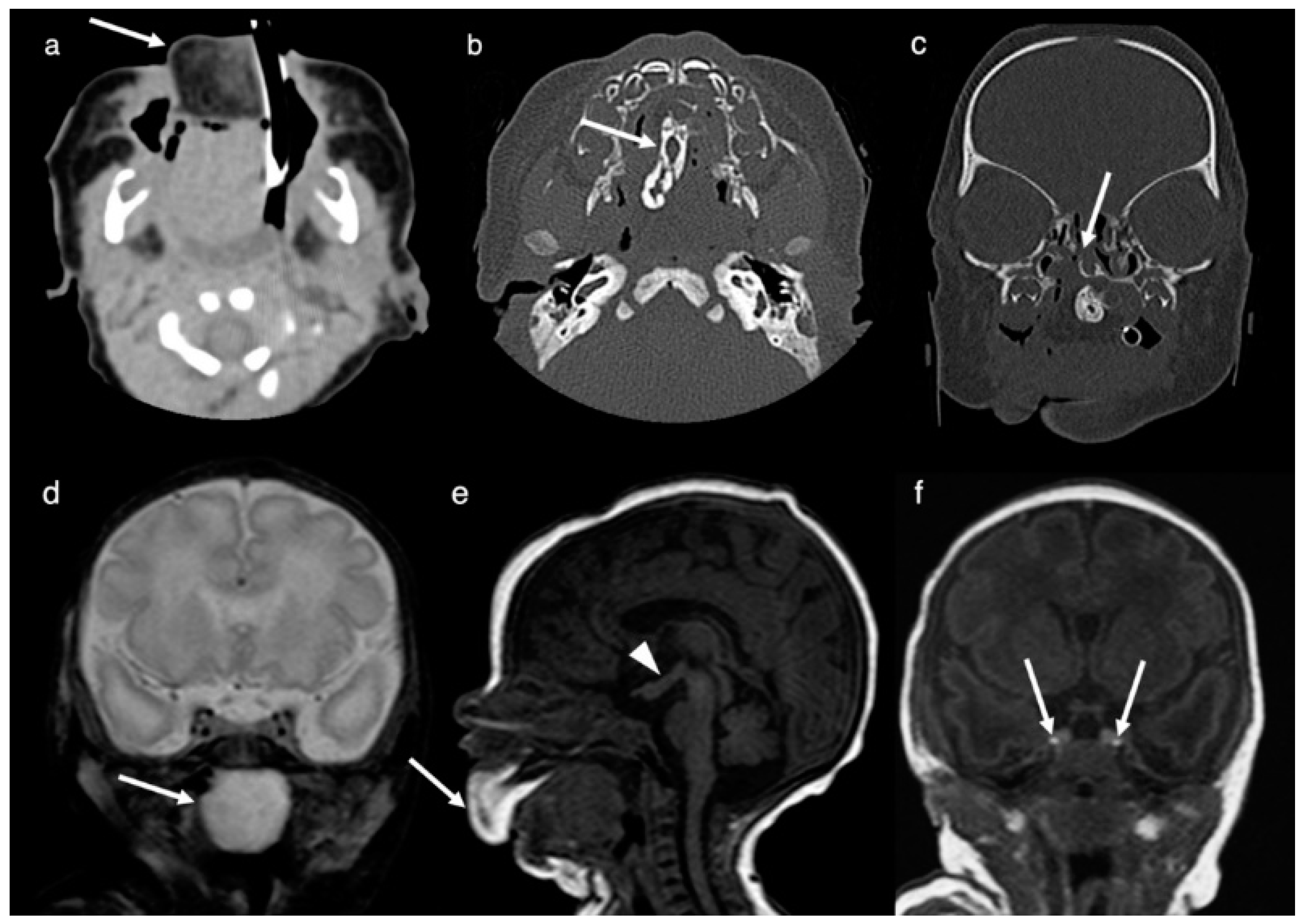 Normal Pituitary Mri T2
