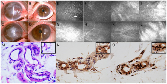 Neuronal Intranuclear Inclusion Disease-Related Neurotrophic Keratitis ...