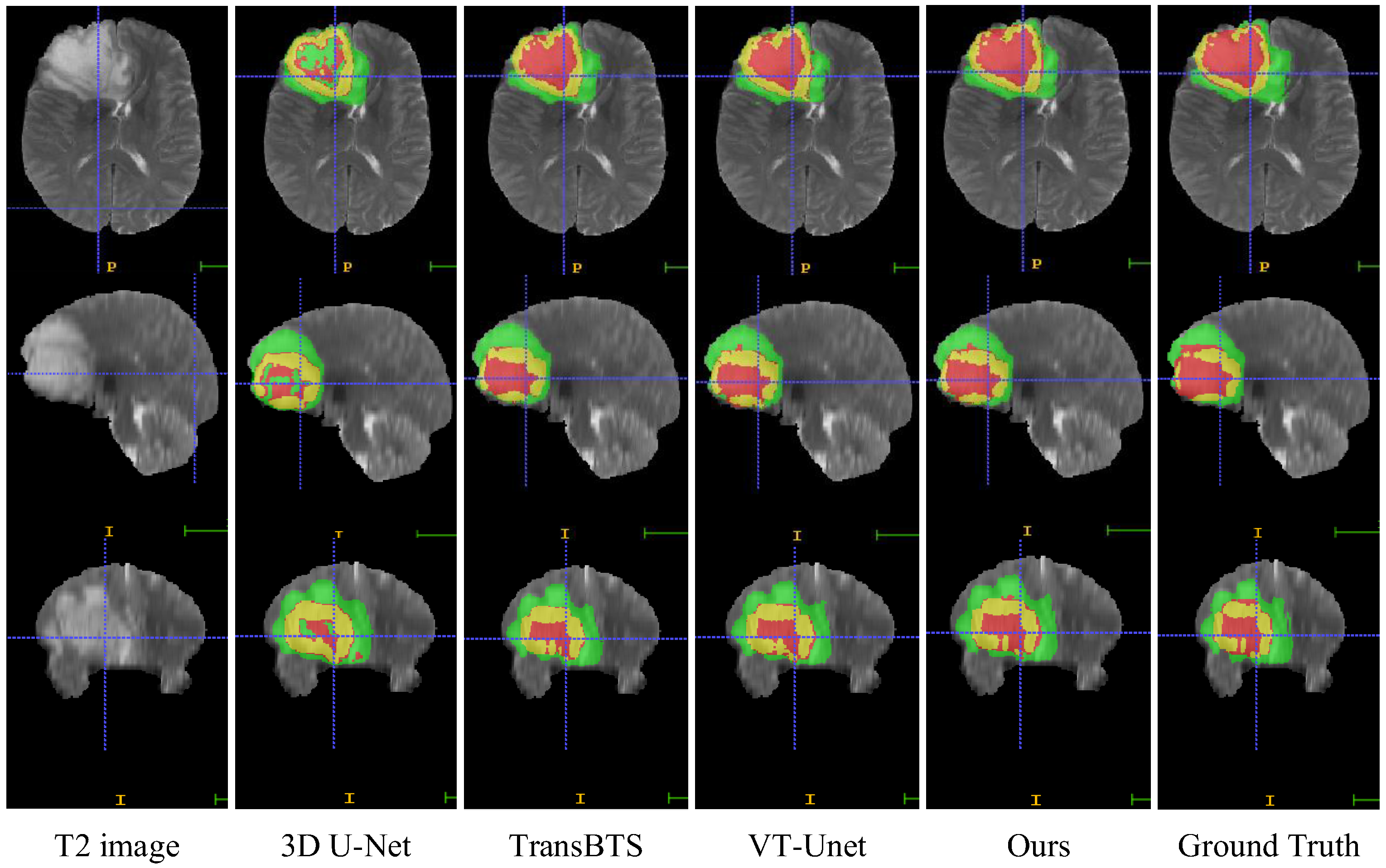 Brain Sciences | Free Full-Text | SwinBTS: A Method for 3D Multimodal Brain Tumor Segmentation ...