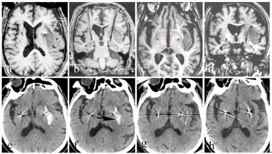 The Long-Term Efficacy, Prognostic Factors, Safety, and Hospitalization ...