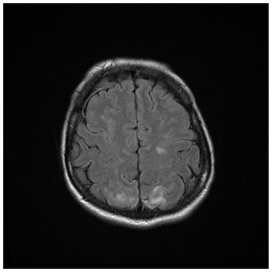 Posterior Reversible Encephalopathy Syndrome Pres Pediatric Posterior