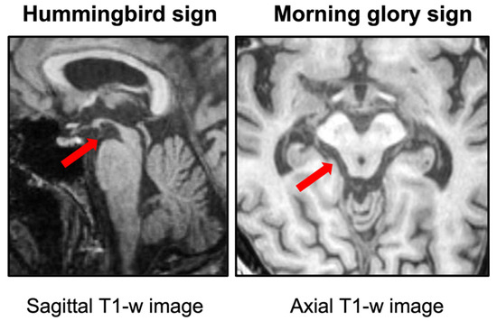 Magnetic Resonance Planimetry in the Differential Diagnosis between ...
