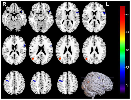 Altered Regional Homogeneity and Amplitude of Low-Frequency ...