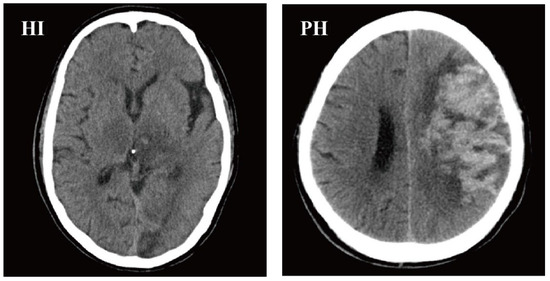 Glucose to Platelet Ratio: A Potential Predictor of Hemorrhagic ...