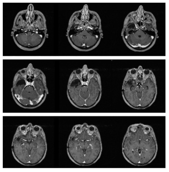 Sixteen-Year Follow-Up in a Cavernous Sinus Hemangiopericytoma ...