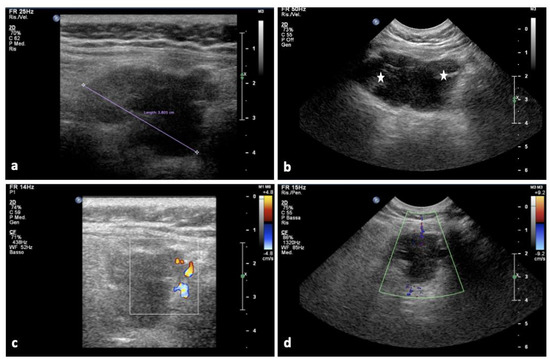 Extra-Neural Metastases of Late Recurrent Myxopapillary Ependymoma to Left Lumbar Paravertebral ...