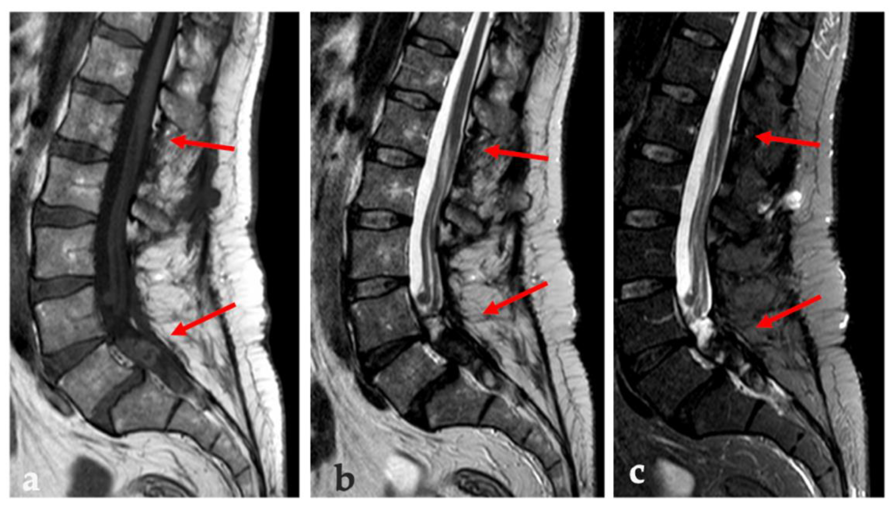 Extra-Neural Metastases of Late Recurrent Myxopapillary Ependymoma to Left Lumbar Paravertebral ...