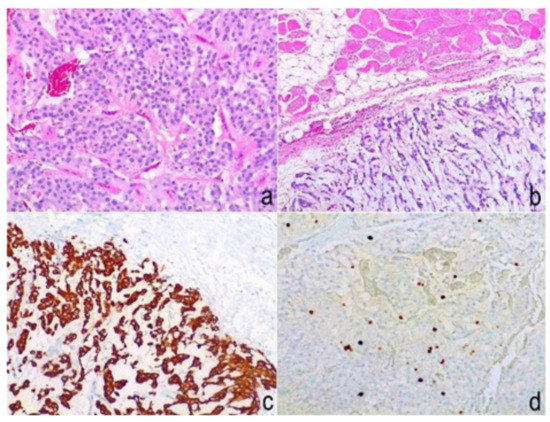 Extra-Neural Metastases of Late Recurrent Myxopapillary Ependymoma to Left Lumbar Paravertebral ...