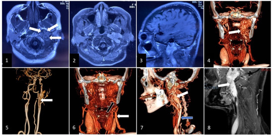 Staged Surgery for Intra-Extracranial Communicating Jugular Foramen ...