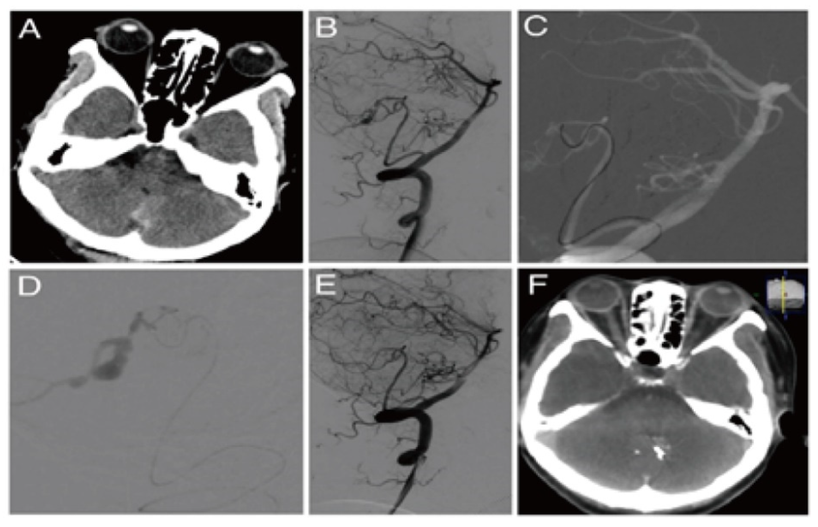 Efficacy of Liquid Embolic Agent Treatment in Hemorrhagic Peripheral Intracranial Aneurysms: A ...