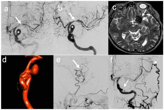 Brain Sciences | Free Full-Text | The Role of Bypass Surgery for the ...