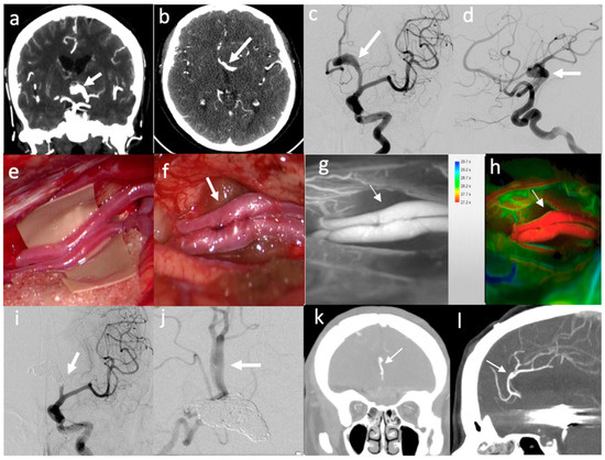 Brain Sciences | Free Full-Text | The Role of Bypass Surgery for the ...