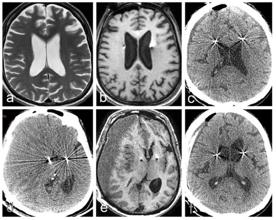 Subdural Effusion Evolves into Chronic Subdural Hematoma after Deep ...