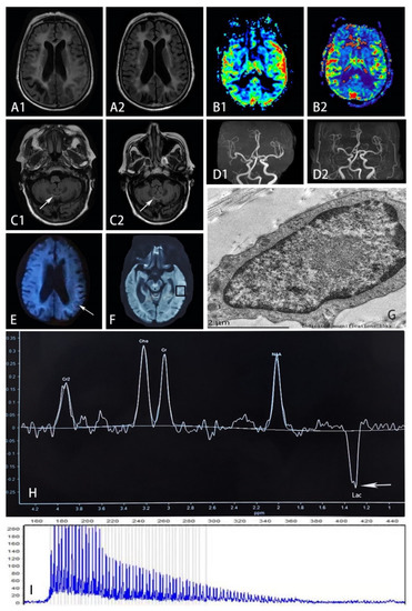 Adult-Onset Neuronal Intranuclear Inclusion Disease with Mitochondrial ...