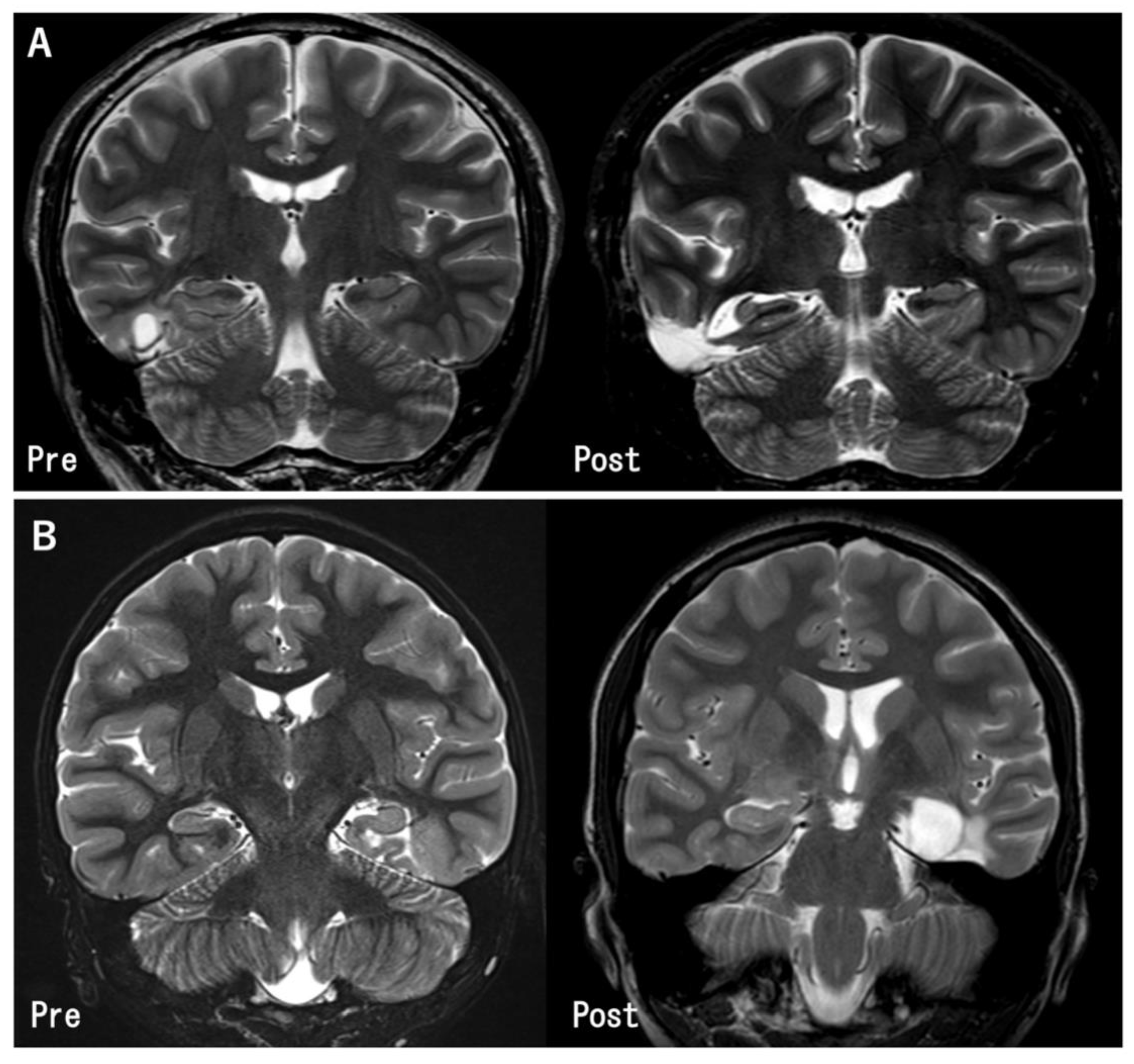 Is Hippocampal Resection Necessary for Low-Grade Epilepsy-Associated ...