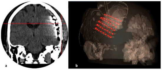The Role of Extra-Operative Cortical Stimulation and Mapping in the ...