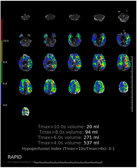 The Application of Software “Rapid Processing of Perfusion and ...
