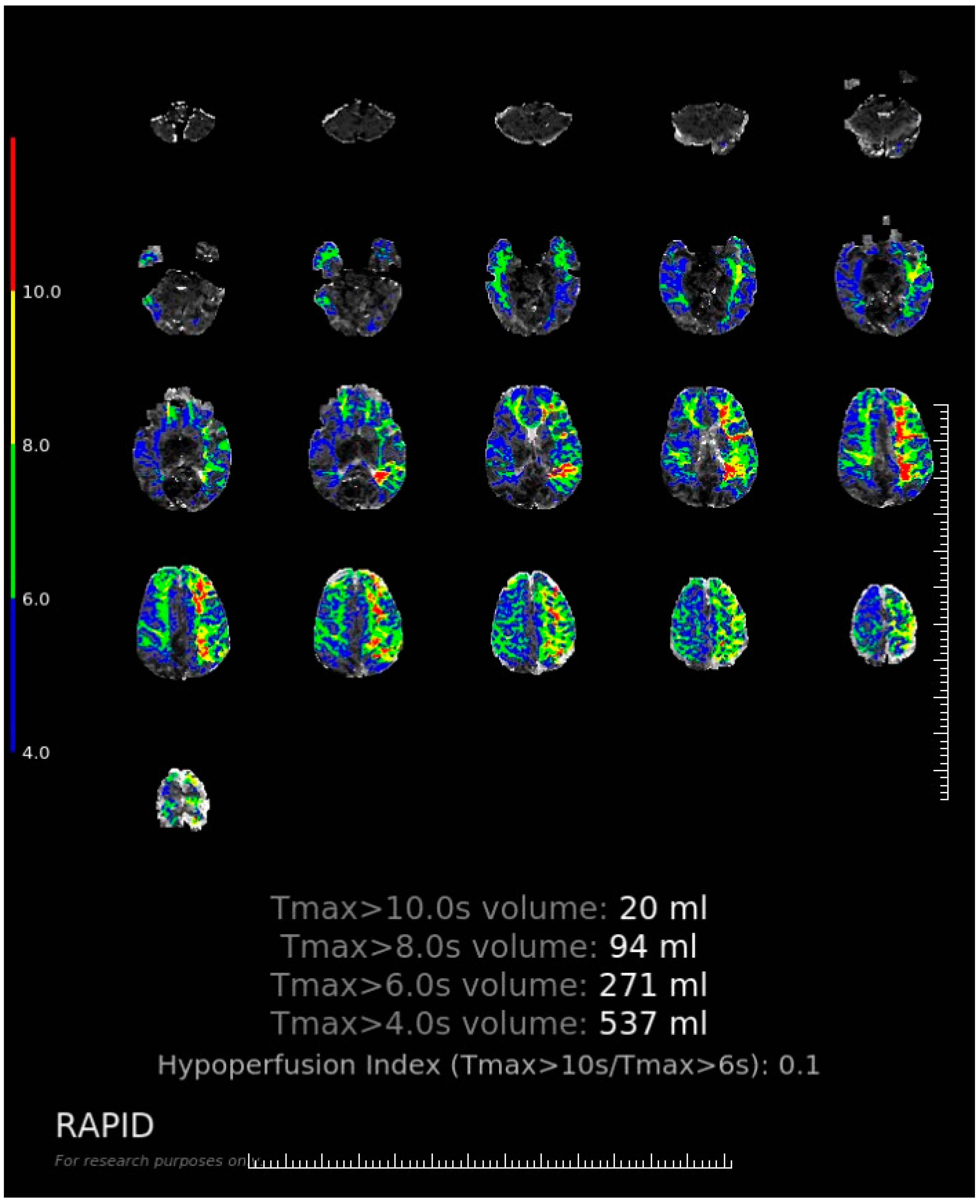 The Application of Software “Rapid Processing of Perfusion and ...