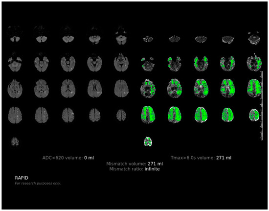 The Application of Software “Rapid Processing of Perfusion and ...