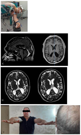 The Ipsilateral Interhemispheric Transprecuneal Approach to the Atrium ...