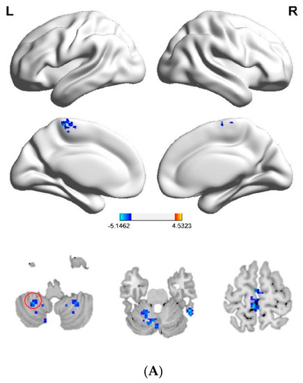 Impaired Inter-Hemispheric Functional Connectivity during Resting State in Female Patients with ...