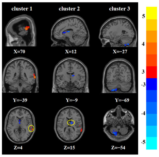 A Study of Differential Resting-State Brain Functional Activity in ...