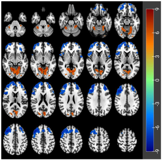 Vigilant Attention, Cerebral Blood Flow and Grey Matter Volume Change ...