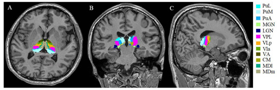 Alterations of Thalamic Nuclei Volumes and the Intrinsic Thalamic ...
