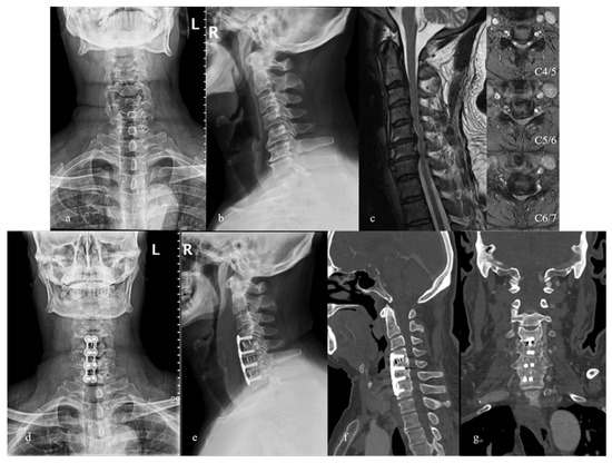 Is the Zero-P Spacer Suitable for 3-Level Anterior Cervical Discectomy ...