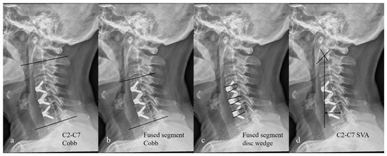 Is the Zero-P Spacer Suitable for 3-Level Anterior Cervical Discectomy ...