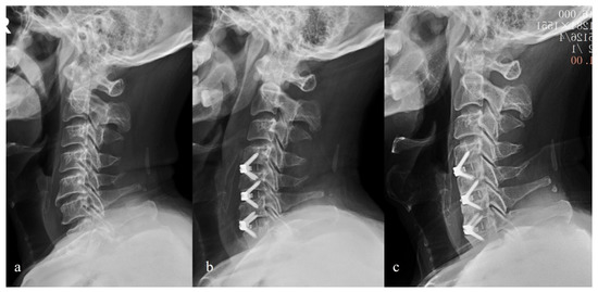 Is the Zero-P Spacer Suitable for 3-Level Anterior Cervical Discectomy ...