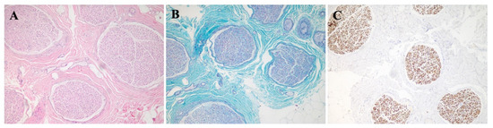 Anti-NF155/NF186 IgG4 Antibody Positive Autoimmune Nodopathy