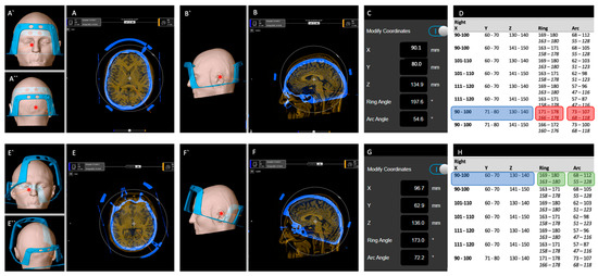 Posterior Fossa Approaches Using the Leksell Vantage Frame with a ...