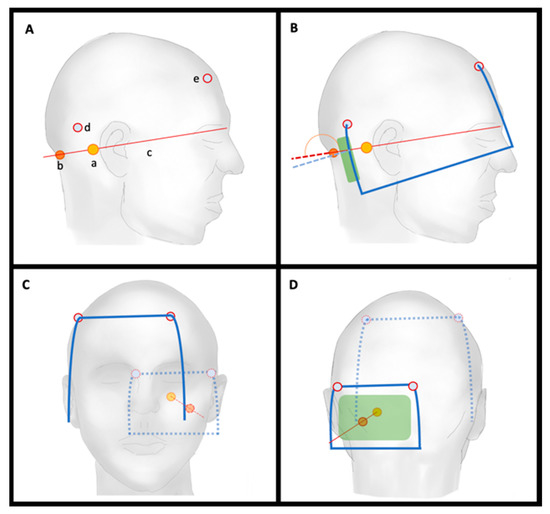 Posterior Fossa Approaches Using the Leksell Vantage Frame with a ...