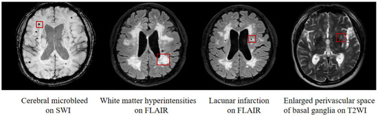 Glymphatic Dysfunction Mediates the Influence of White Matter ...