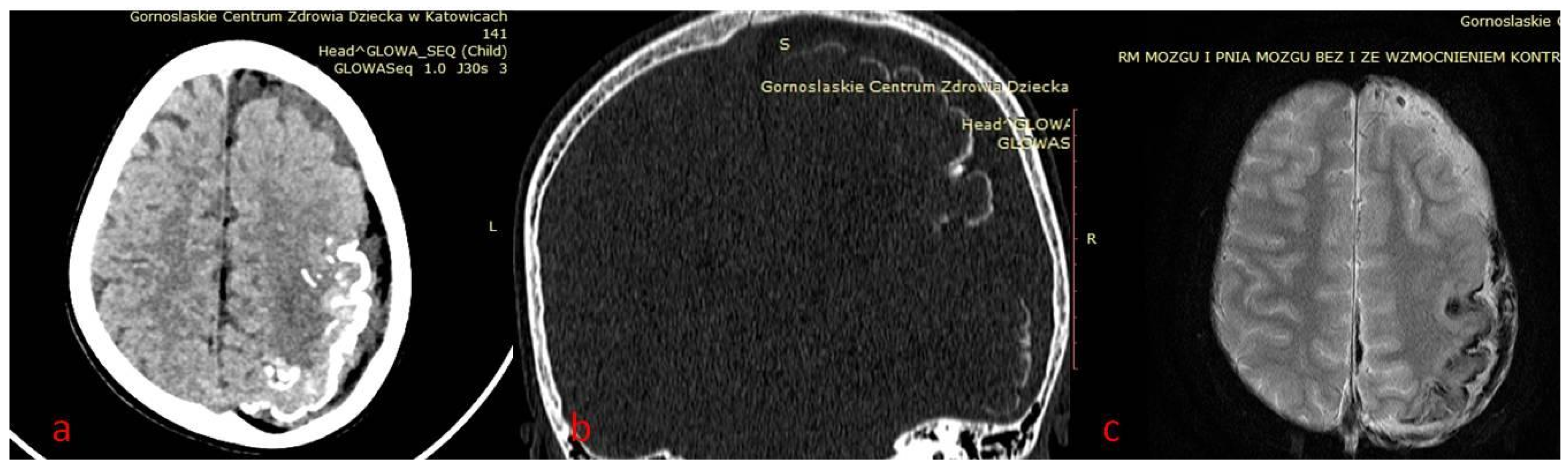 Encephalocraniocutaneous Lipomatosis, a Radiological Challenge: Two ...