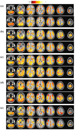 Effects of Physiological Signal Removal on Resting-State Functional MRI ...