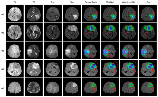 Axial Attention Convolutional Neural Network for Brain Tumor Segmentation with Multi-Modality ...