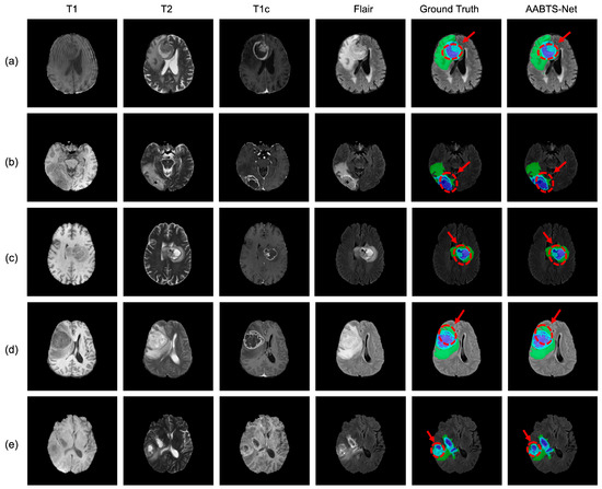 Axial Attention Convolutional Neural Network for Brain Tumor ...