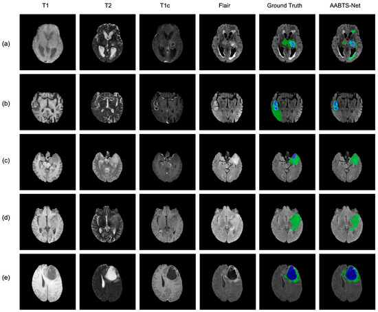 Axial Attention Convolutional Neural Network for Brain Tumor Segmentation with Multi-Modality ...