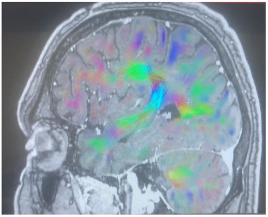 Structural Connectivity Reorganization Based on DTI after Cingulotomy ...